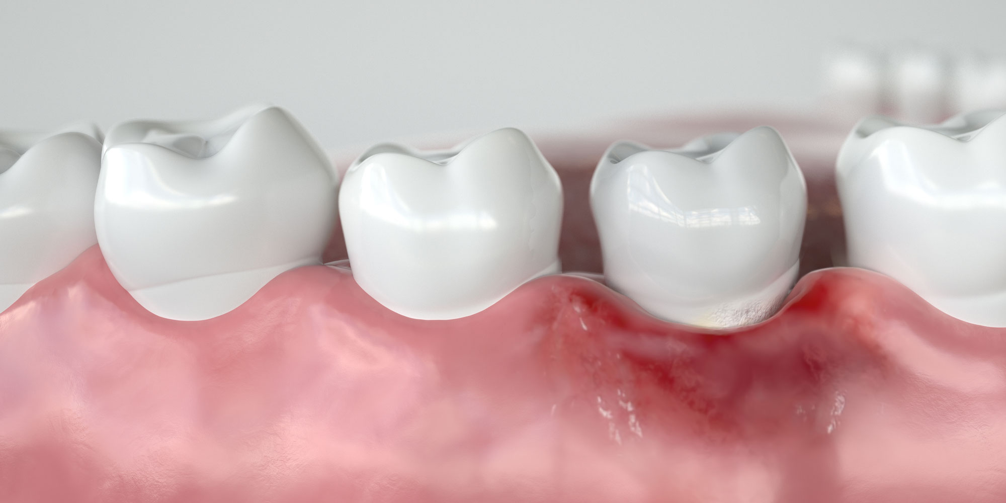 Gingivectomy | Frenectomy | Phoenix Metro, AZ | Implants & Periodontics
